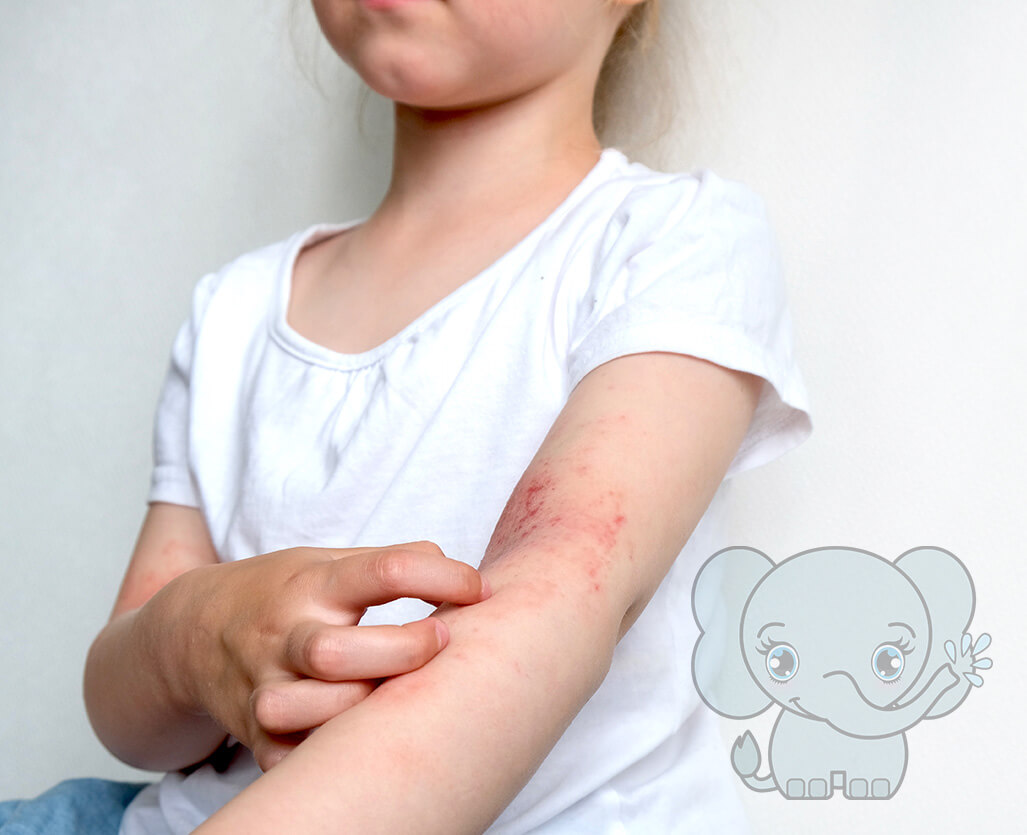 Cómo la mometasona puede ayudar en el tratamiento de la dermatitis ...